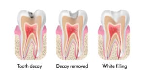 Filling Fell Out What Should I Do? - Pickett Family Dental