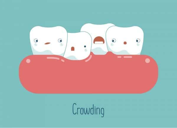 How to Fix Crowded Teeth - Pickett Family Dental