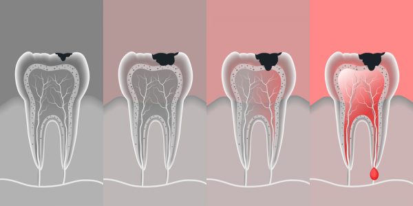 Diagnodent Cavity Detection - Pickett Family Dental