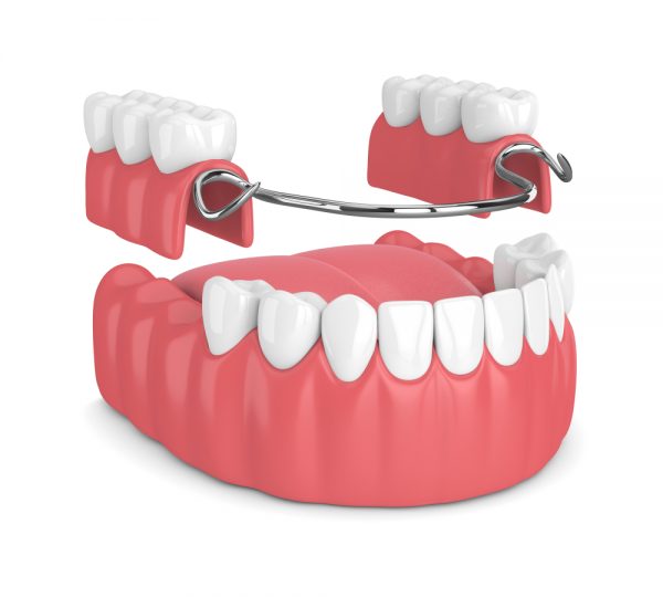 Partial Dentures on Front Teeth - Pickett Family Dental