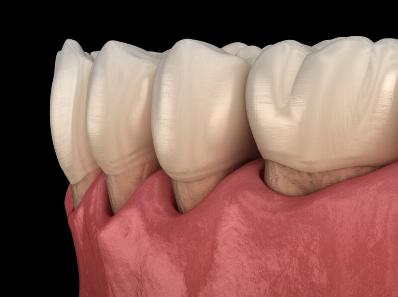 Periodontal Maintenance Cleaning - Pickett Family Dental