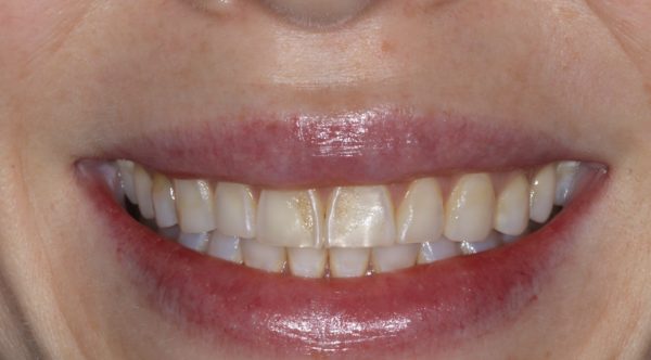 Tooth Discoloration: Causes, Solutions, and Prevention - Pickett Family ...