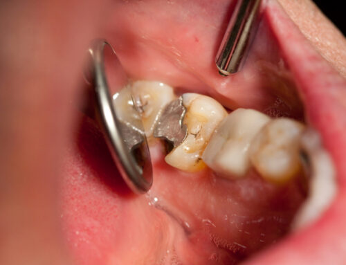 Temporary Dentures vs. Permanent Dentures - Pickett Family Dental