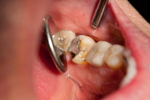 Everything You Need To Know About Dental Fillings - Pickett Family Dental