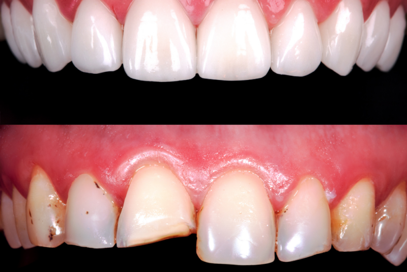 Tooth Reshaping - Pickett Family Dental